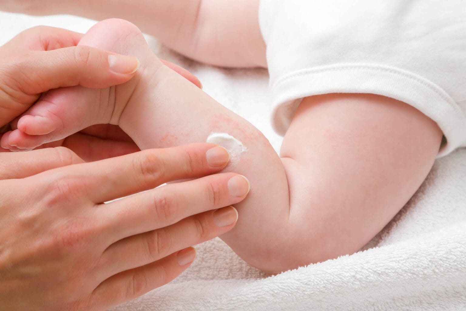 Eczéma enfant : quelles sont les solutions possibles