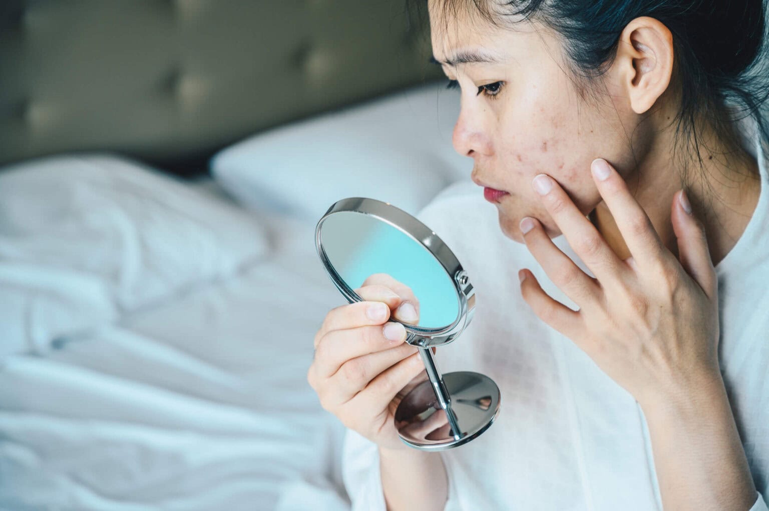 Acné kystique : causes, symptômes et traitements