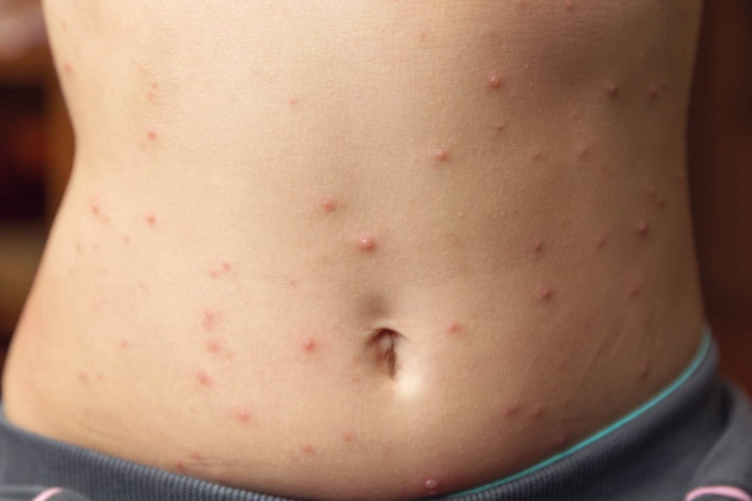 Bouton varicelle : les reconnaître pour mieux les soigner