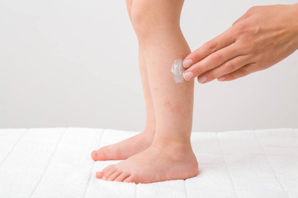 Urticaire chez les bébés : causes, symptômes et traitements